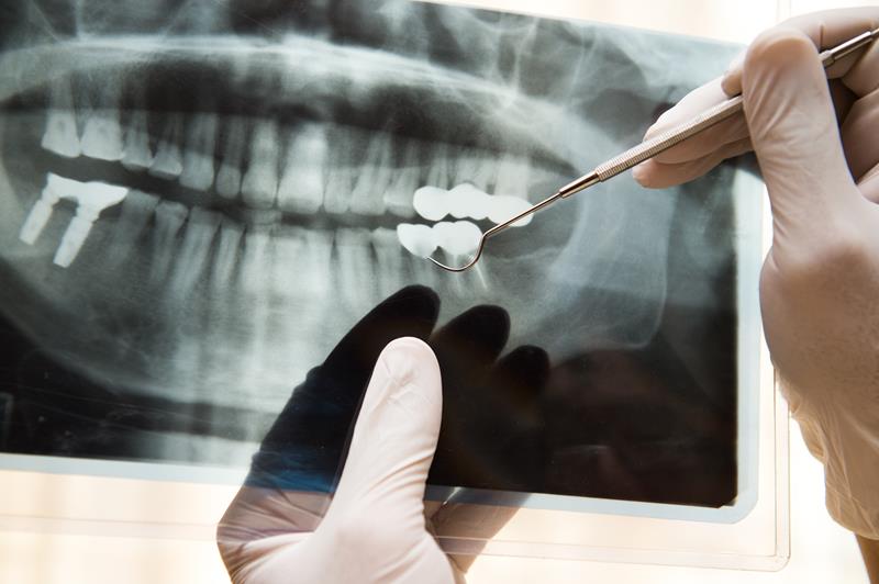 Digital Dental X Rays in Eagan, MN | Shirene Orandi, DDS